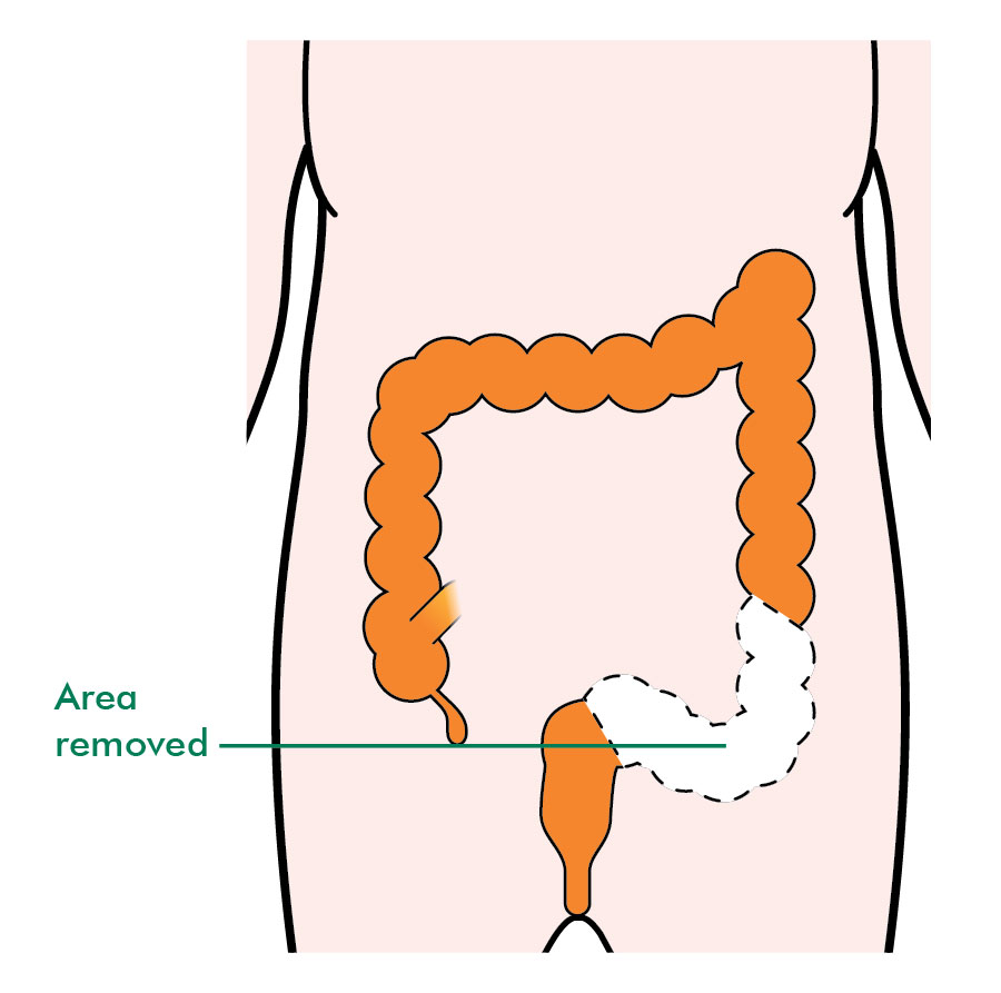 Types Of Surgery For Colon Cancer Information And Support Macmillan Cancer Support