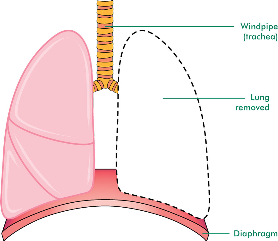 Surgery for lung cancer - Information and support - Macmillan Cancer ...