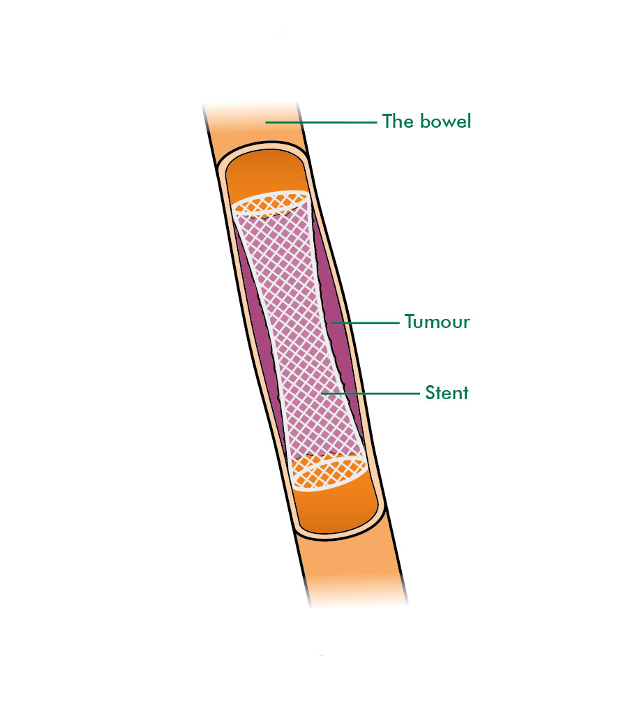 Types of surgery for rectal cancer - Information and support ...