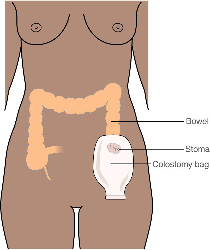 Gn dige Frau Fortsetzen L gner Difference Between Stoma And Colostomy