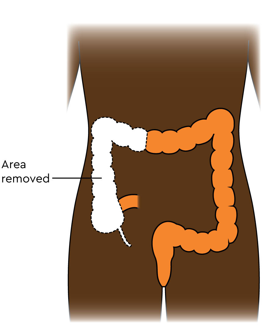 Surgery to remove colon cancer - Macmillan Cancer Support