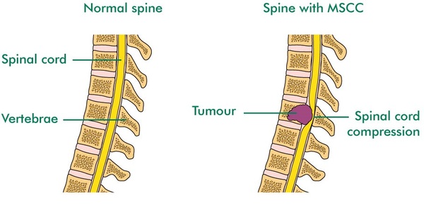 Malignant spinal cord compression (MSCC) - Macmillan Cancer Support