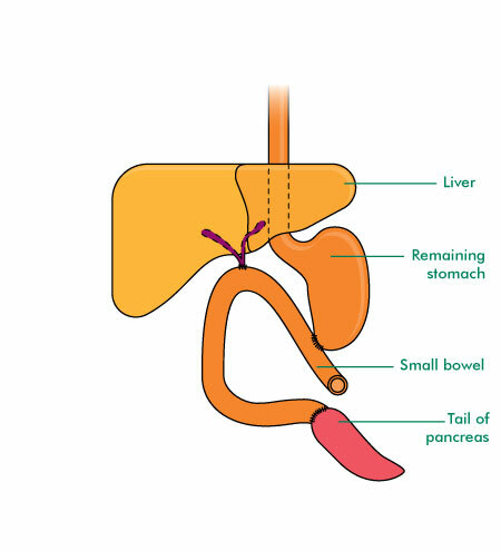 Types of surgery for pancreatic cancer - Macmillan Cancer Support