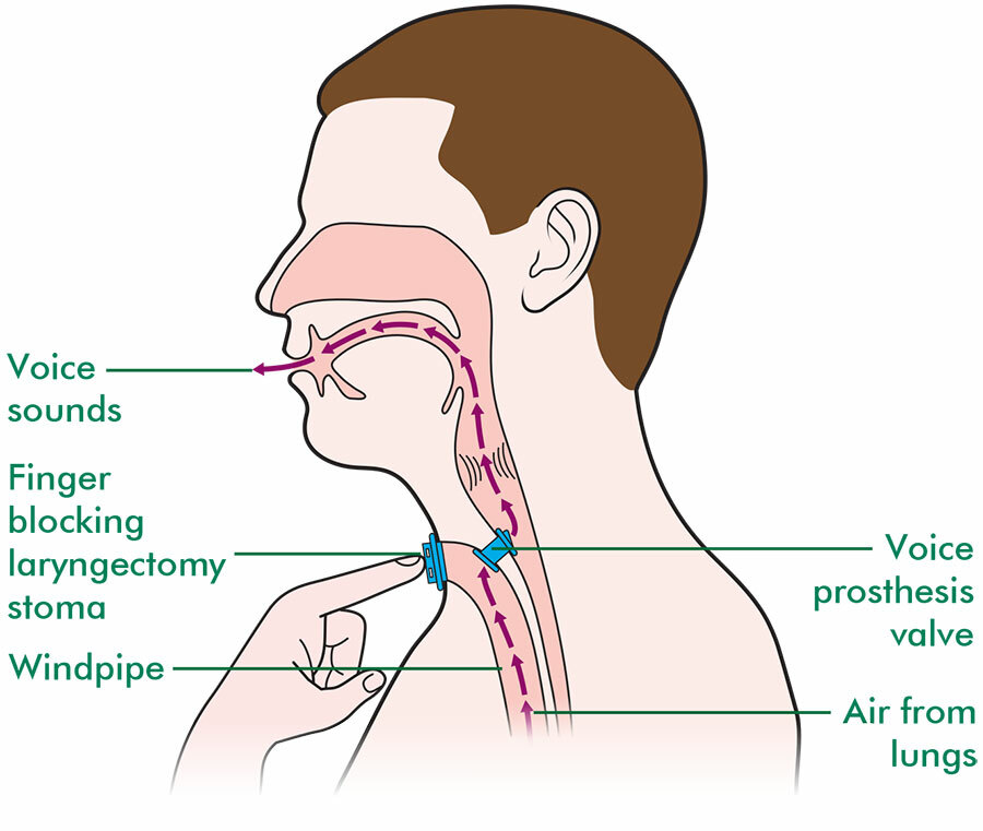 Laryngectomy stoma - Macmillan Cancer Support Laryngectomy stoma - Macmillan Cancer Support
