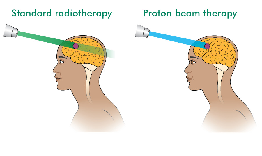 Proton beam therapy - Macmillan Cancer Support
